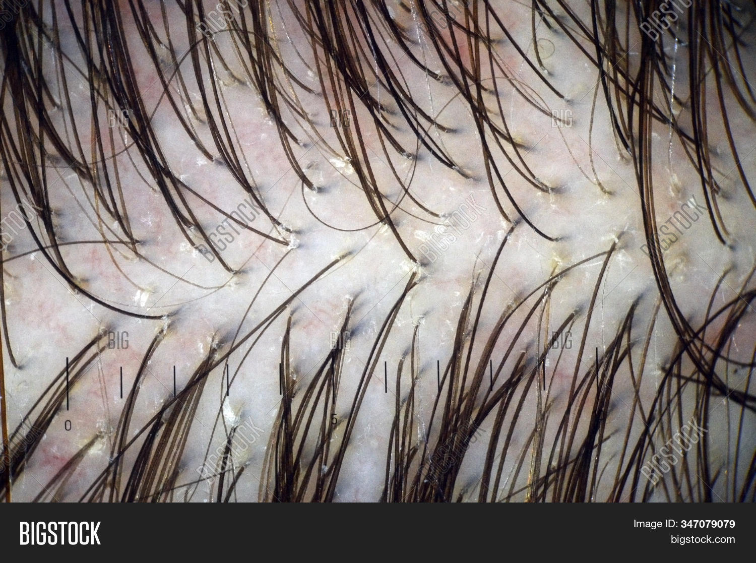 Scalp Hair Multiple Image & Photo (Free Trial) | Bigstock