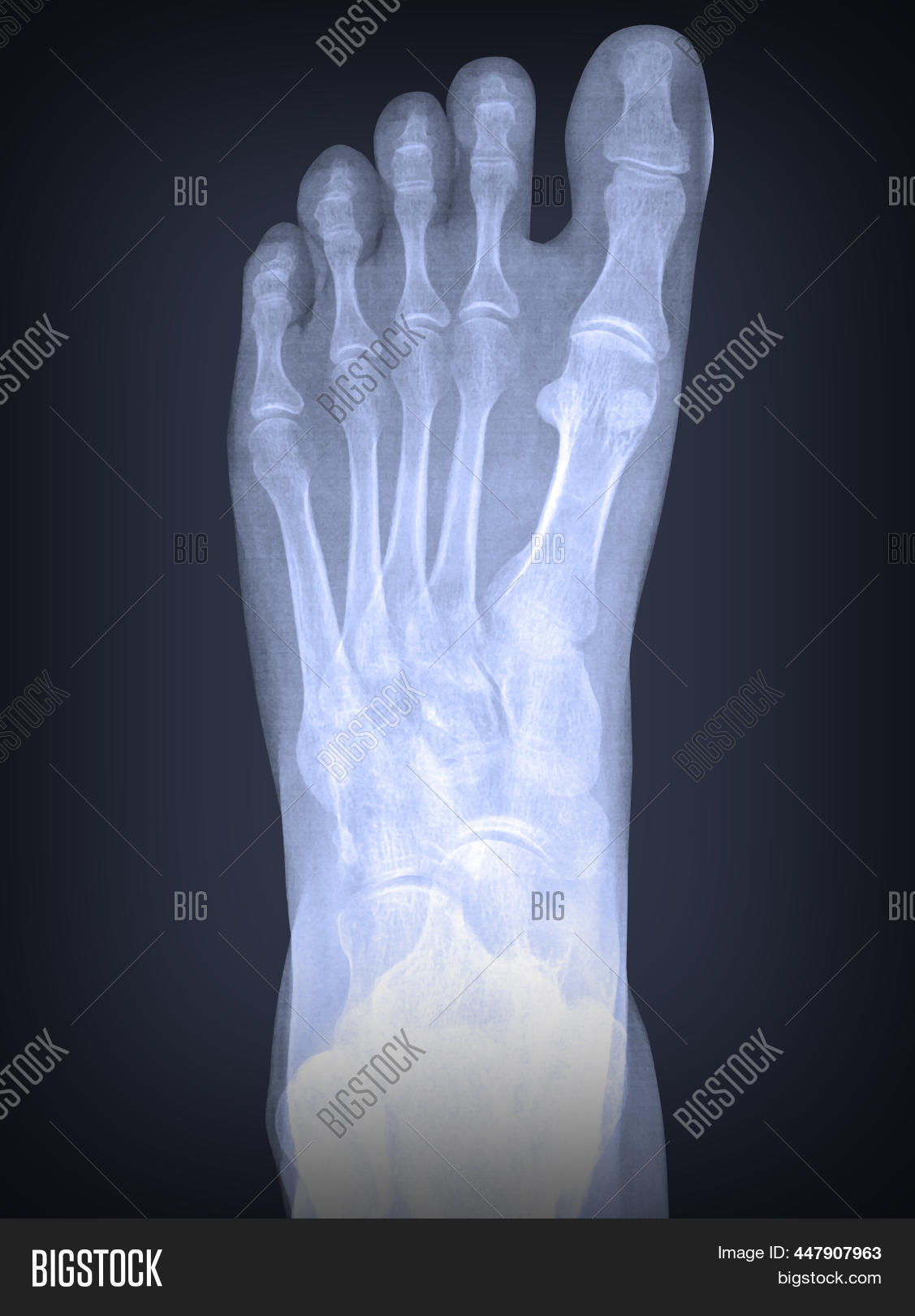X-ray Left Foot Image & Photo (Free Trial) | Bigstock