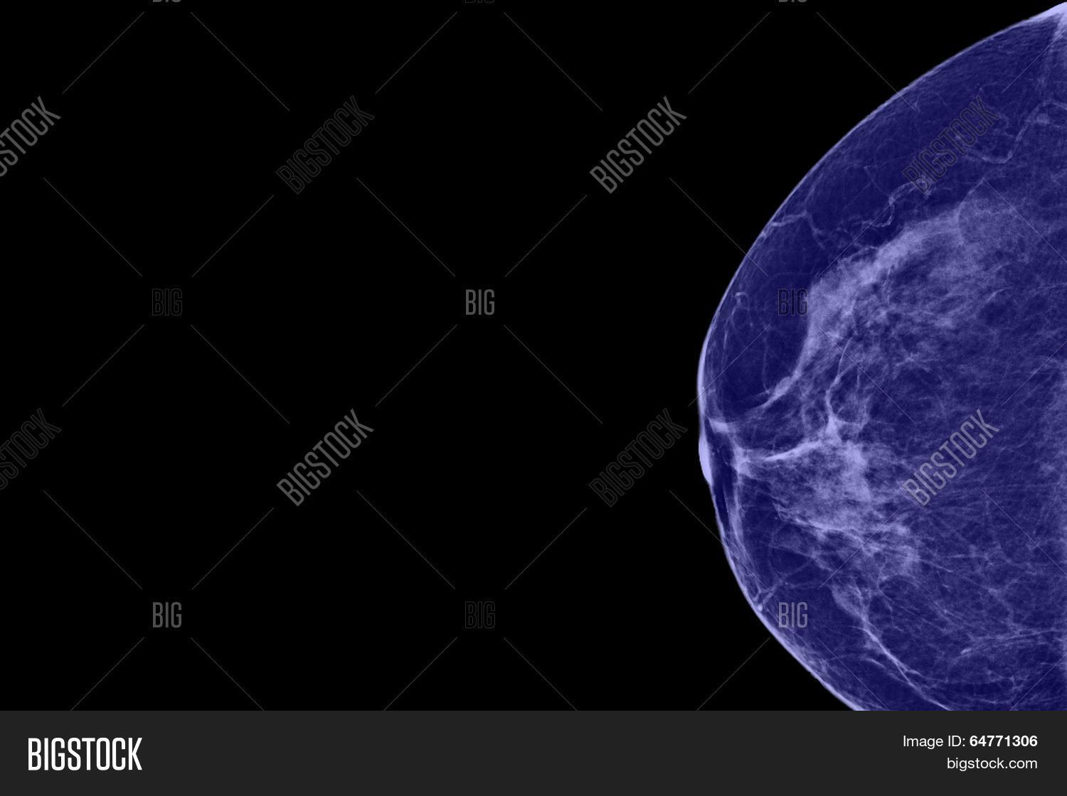 Lateral Mammogram Image & Photo (Free Trial) | Bigstock