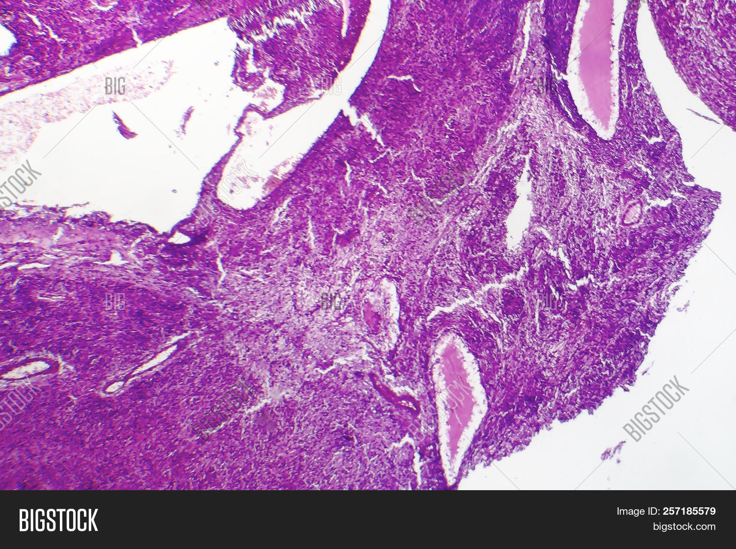 Fibrosarcoma, Image & Photo (Free Trial) | Bigstock