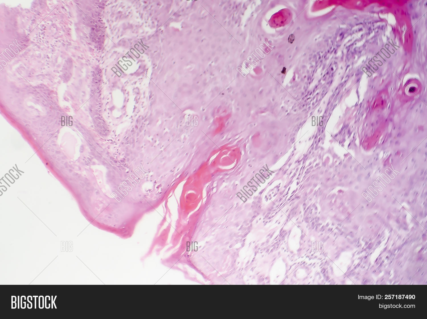 Cutaneous Squamous Image & Photo (Free Trial) | Bigstock