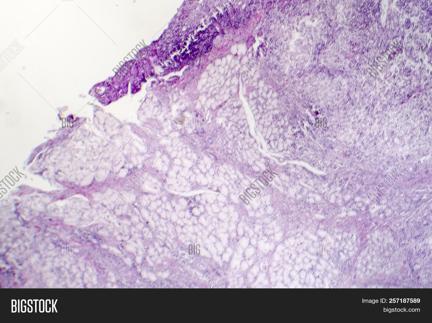 Mucinous Carcinoma Image & Photo (Free Trial) | Bigstock