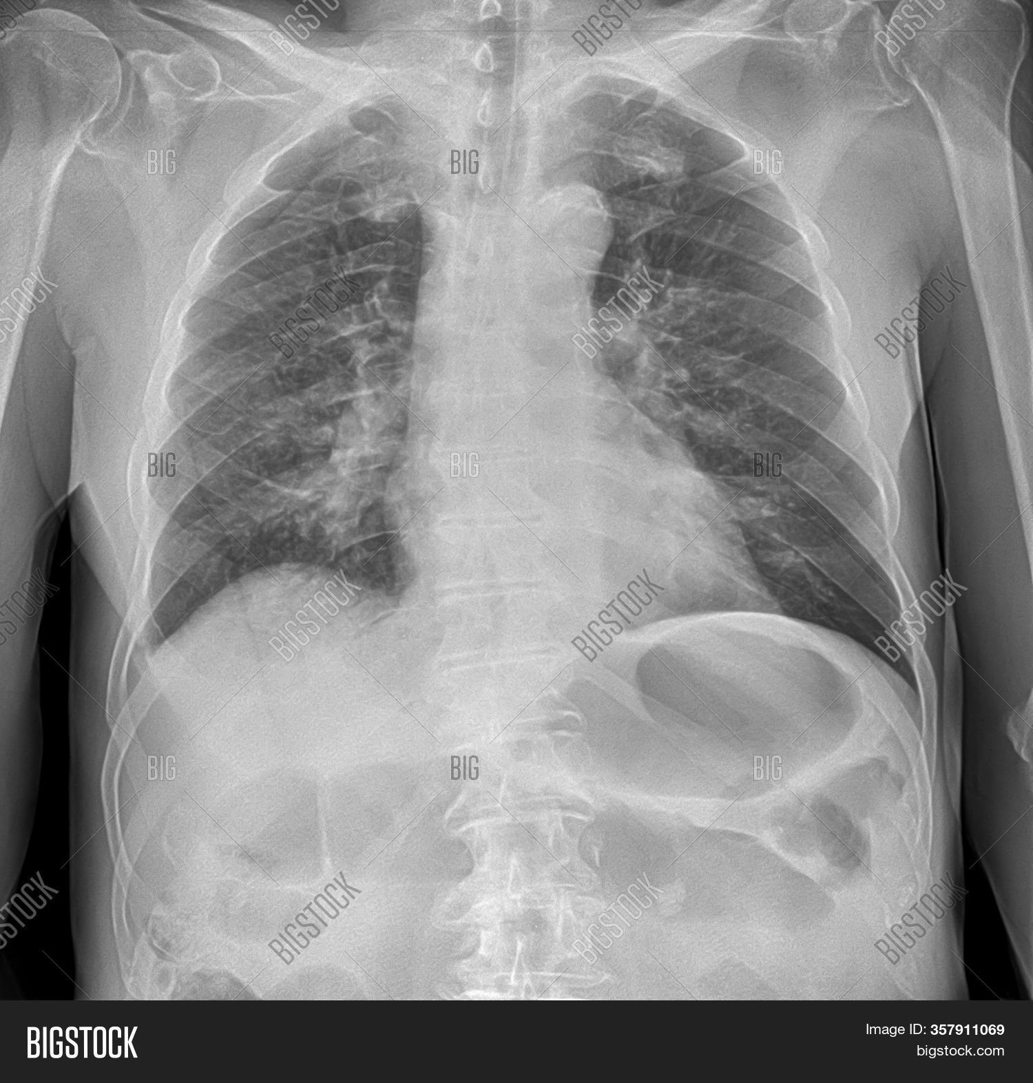Xray Of Healthy Human Lungs On Lightbox Stock Photo X-rays of light stock photo. Image of health ...