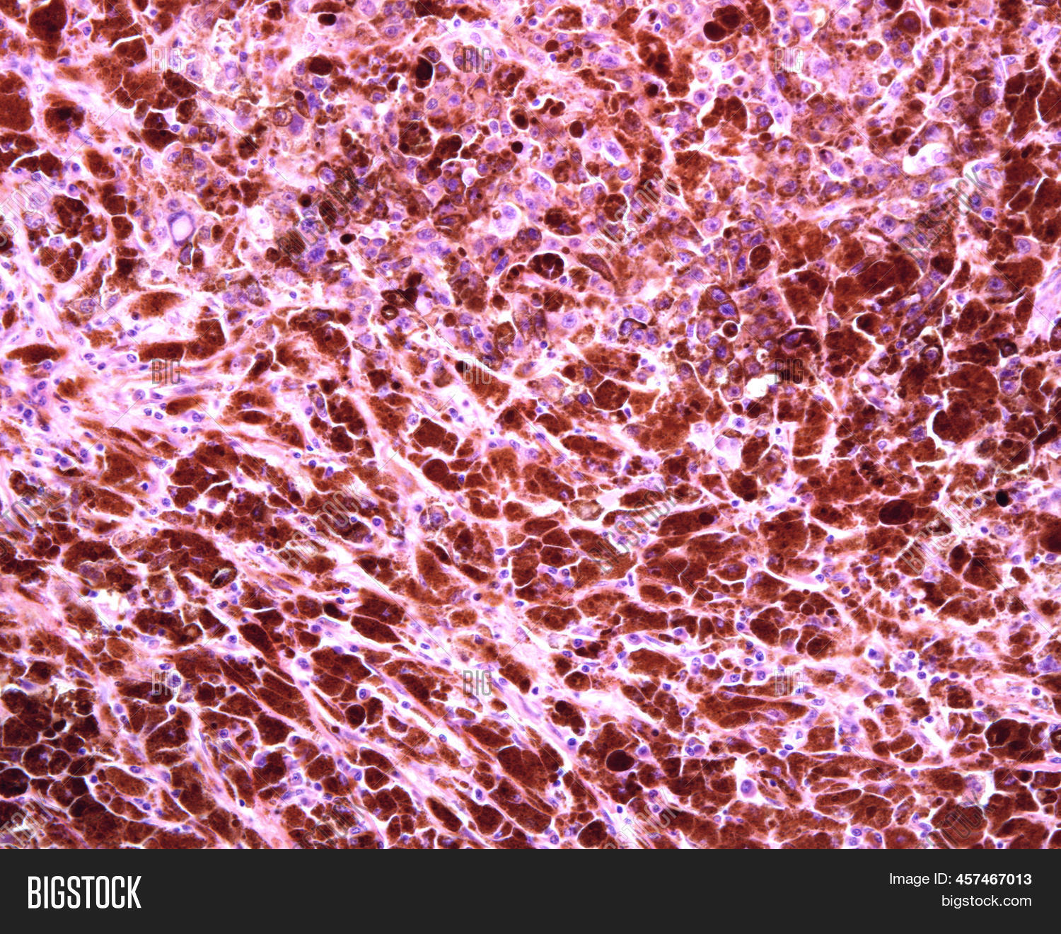 Human Lymph Node. Image & Photo (Free Trial) | Bigstock