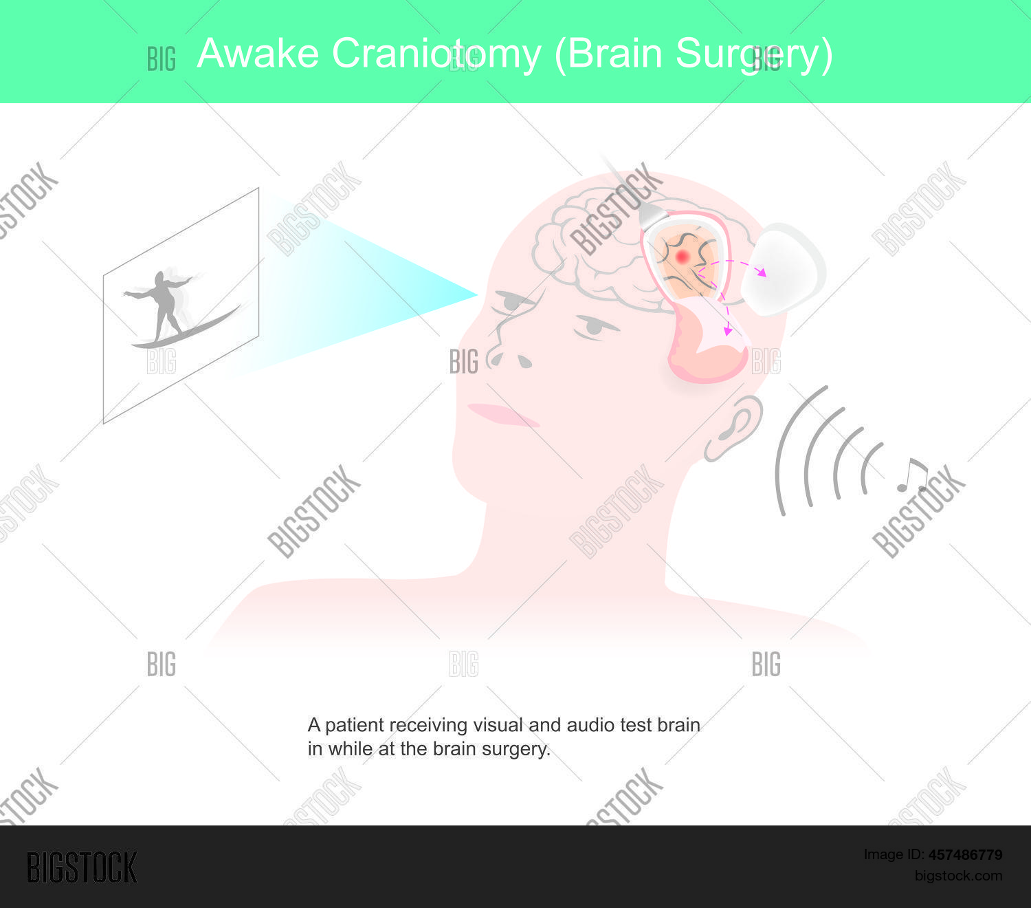Awake Craniotomy. Vector & Photo (Free Trial) | Bigstock