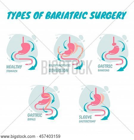 Types Bariatric Vector & Photo (Free Trial) | Bigstock
