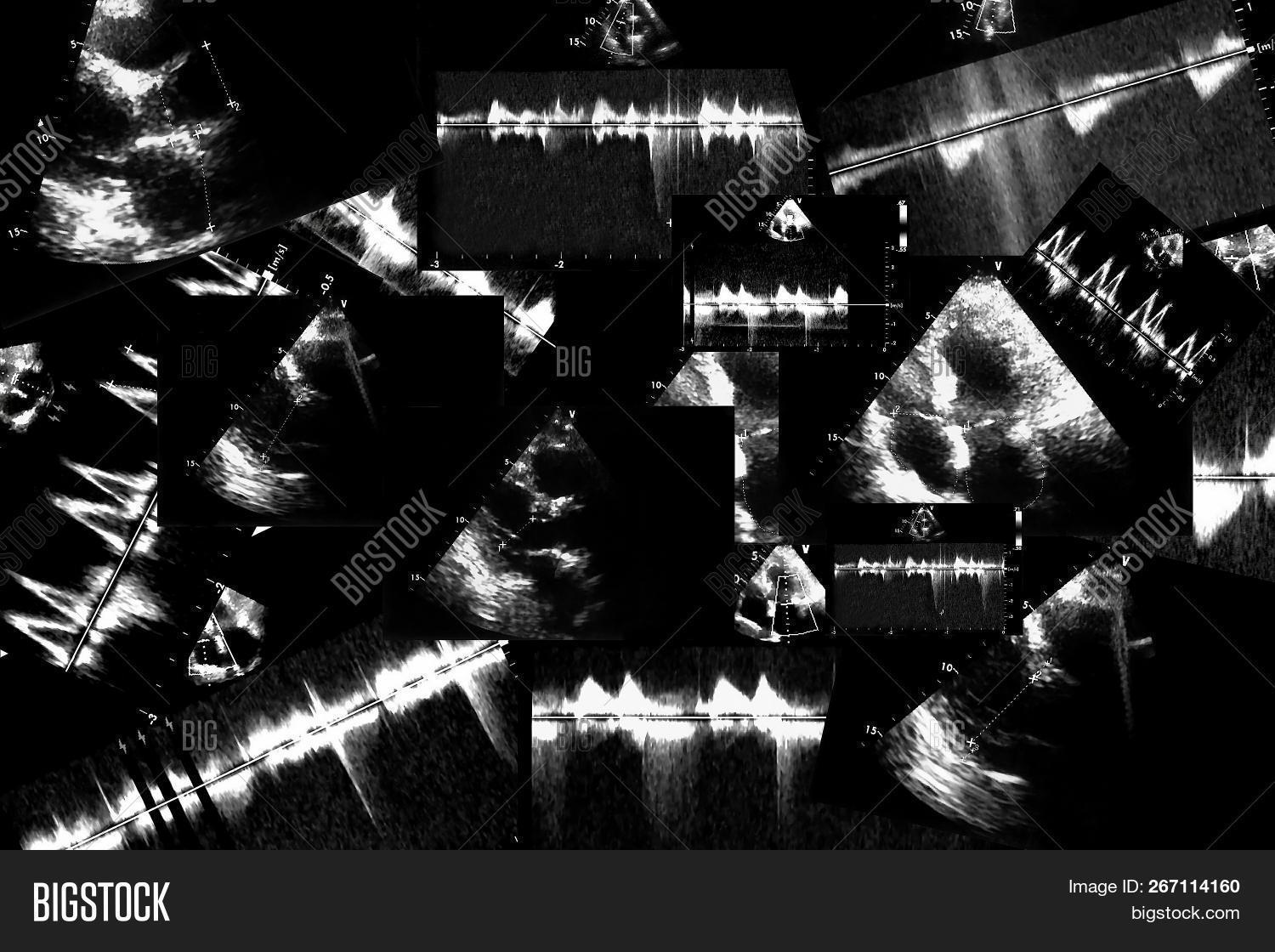Cardiac Ultrasound Image & Photo (Free Trial) | Bigstock