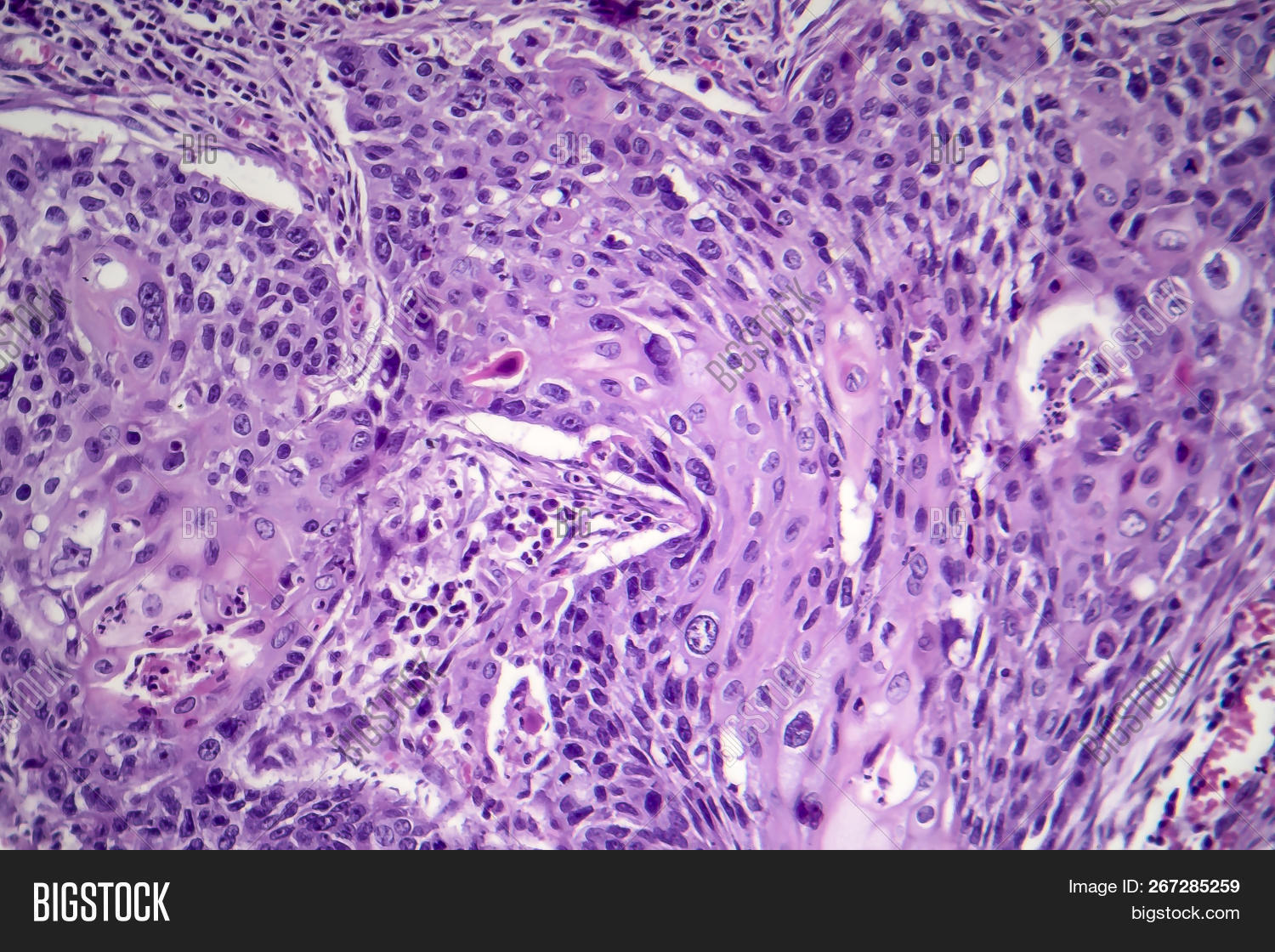 Lung Cancer Cells Under Microscope