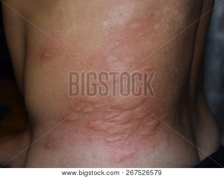 Allergy Skin Back Image & Photo (Free Trial) | Bigstock