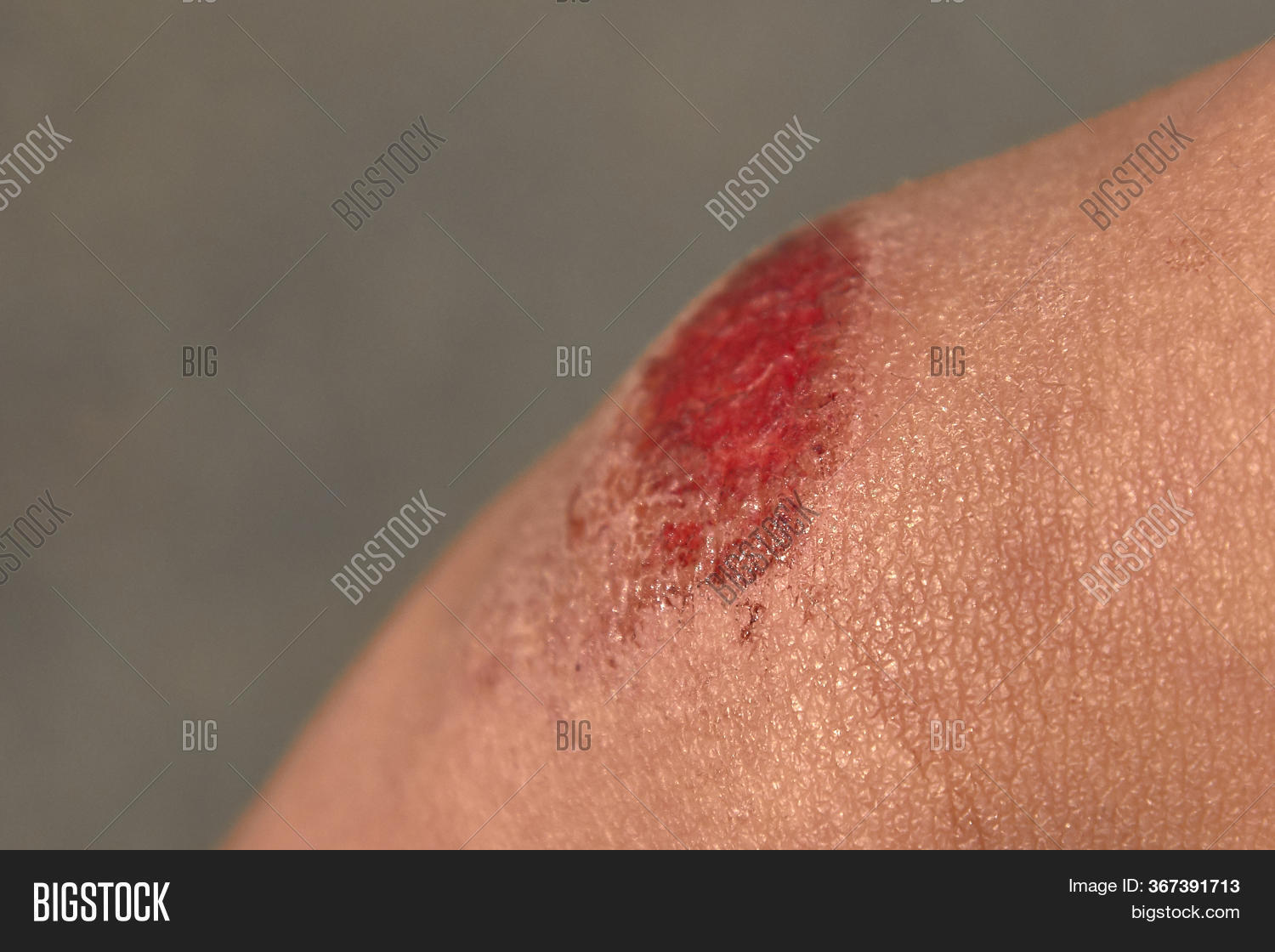 Bruised Wound On Knee Image & Photo (Free Trial) | Bigstock