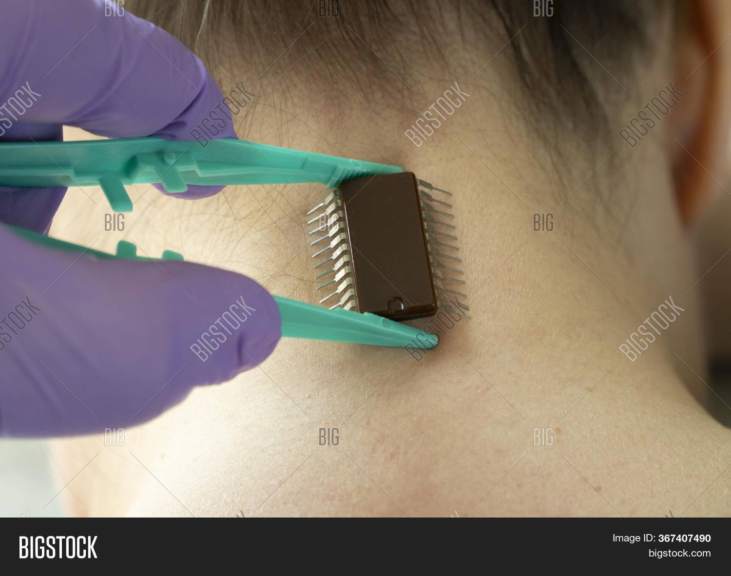 Implantation Chip Image & Photo (Free Trial) | Bigstock