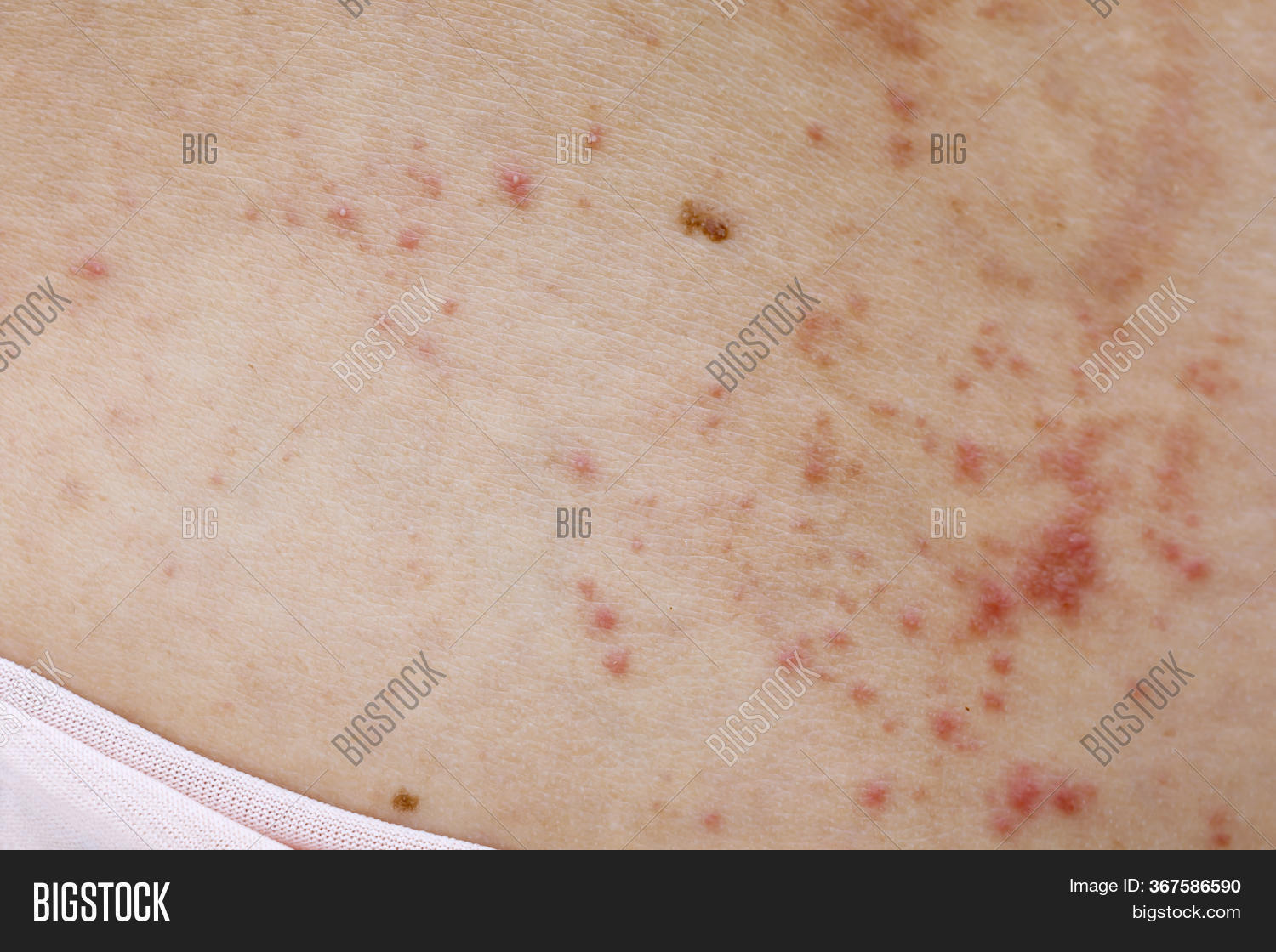 Skin Disease Prickly Image & Photo (Free Trial) | Bigstock