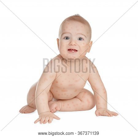 Little Child Red Rash Image & Photo (Free Trial) | Bigstock