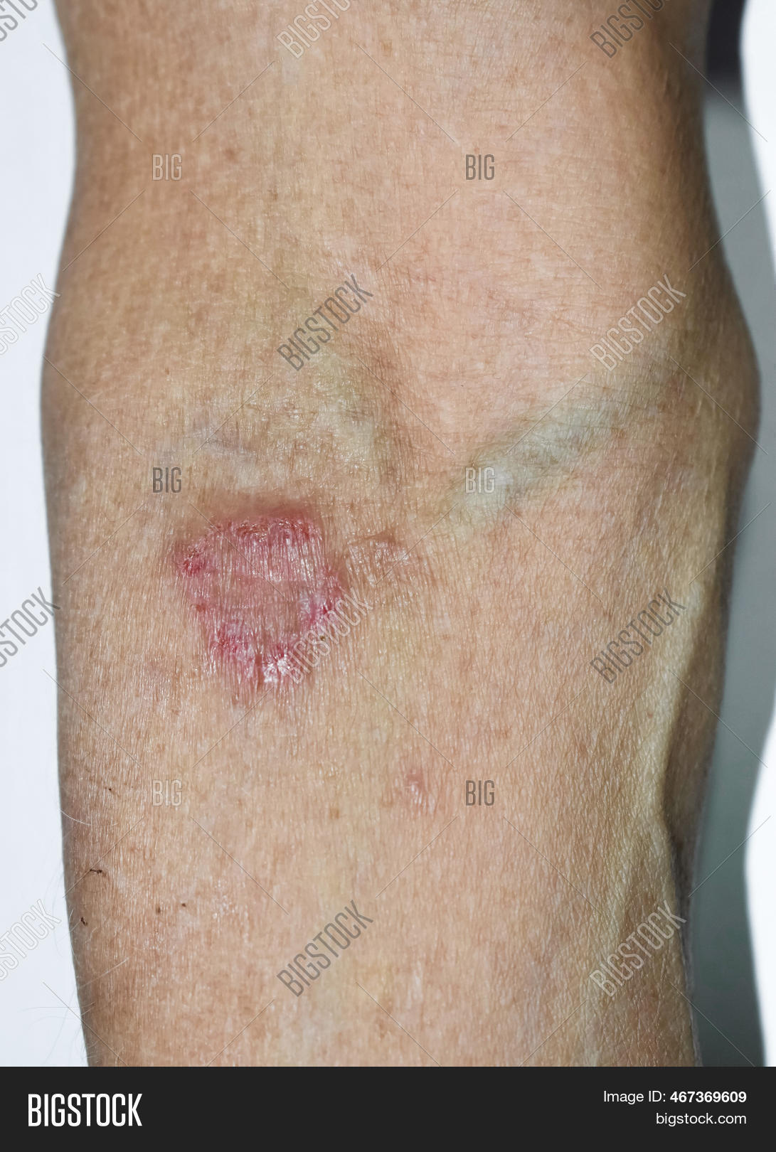 Tinea Corporis Image & Photo (Free Trial) | Bigstock