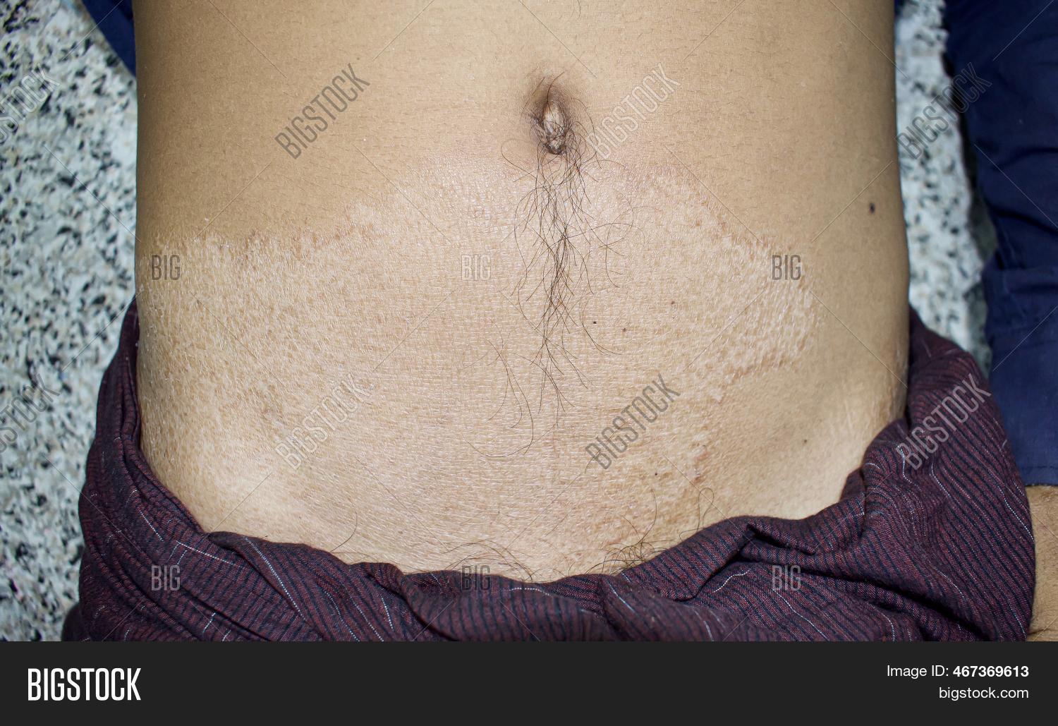 Ringworm Rash On Stomach 4362