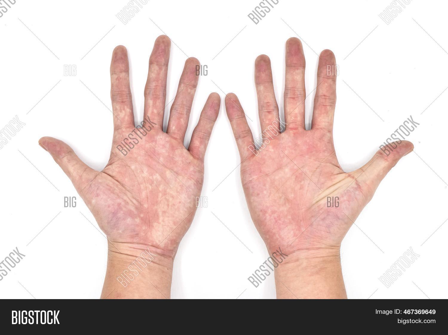 Cyanotic Hands Image & Photo (Free Trial) | Bigstock