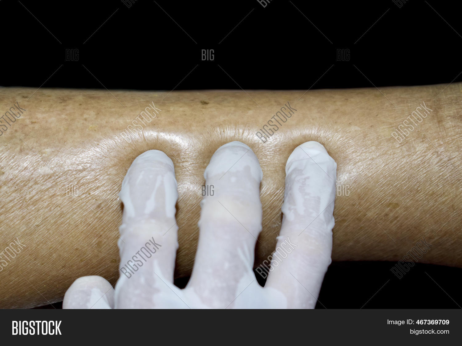 Imagen y foto Pitting Edema Lower (prueba gratis) | Bigstock