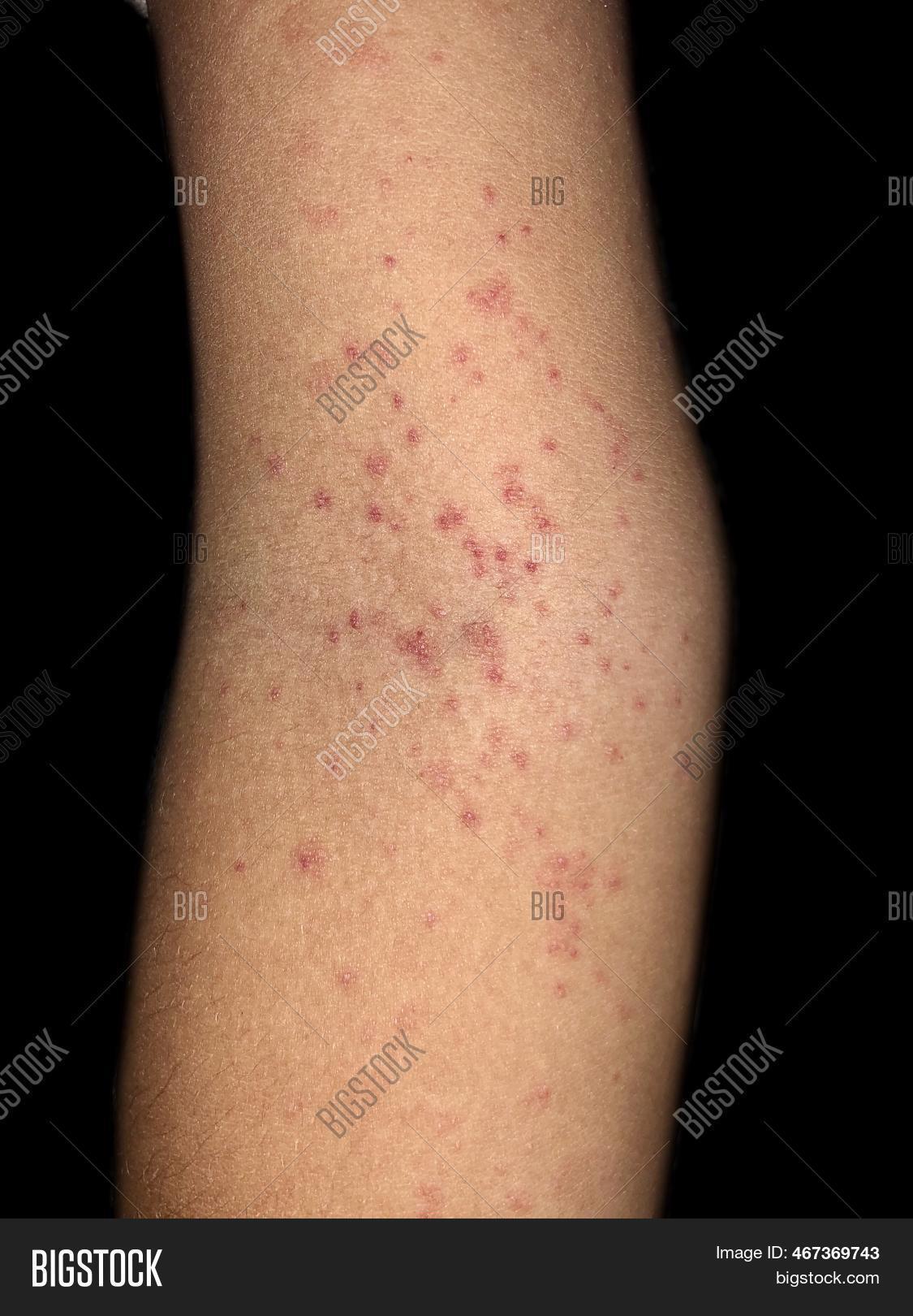 Multiple Red Spots Image & Photo (Free Trial) | Bigstock