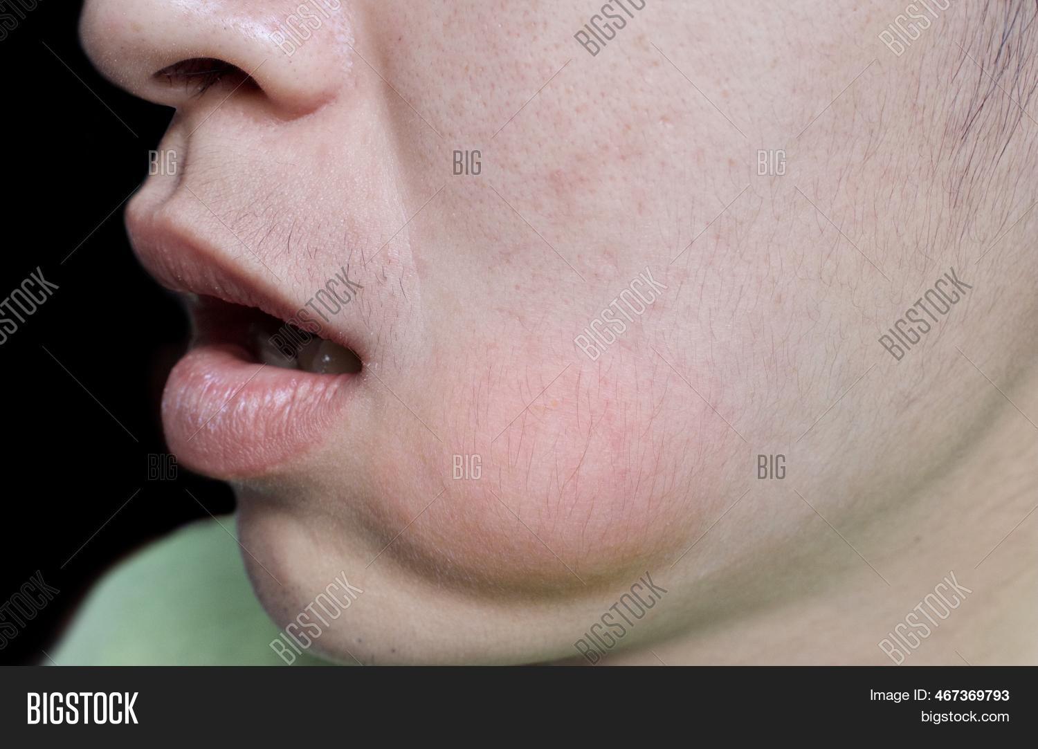 Swelling Cheek Asian Image & Photo (Free Trial) | Bigstock