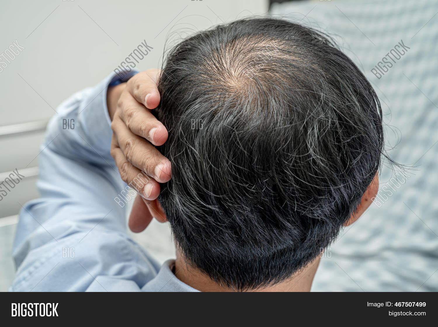 Bald Middle Head Begin Image & Photo (Free Trial) | Bigstock