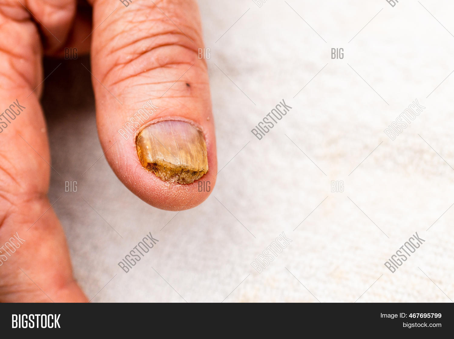 Nail Fungus Infection Image & Photo (Free Trial) | Bigstock