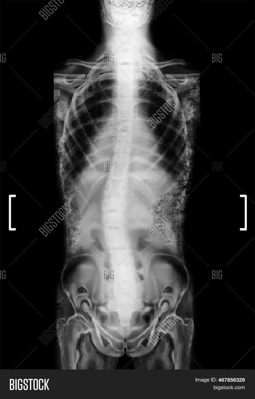 X-ray Human Spine Image & Photo (Free Trial) | Bigstock