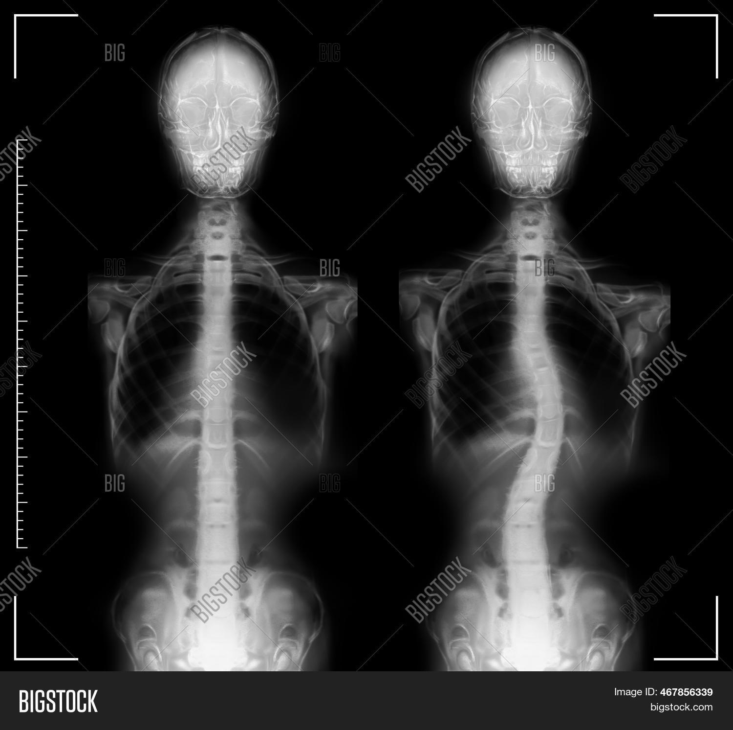 X-rays Human Normal Image & Photo (Free Trial) | Bigstock
