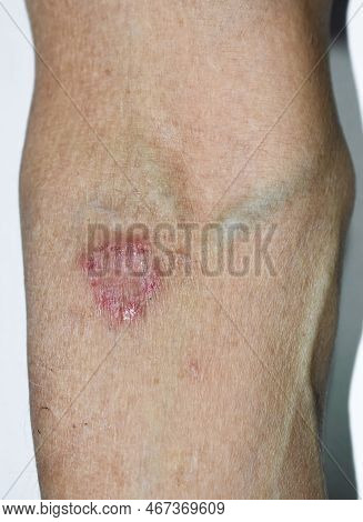 Tinea Corporis Image & Photo (Free Trial) | Bigstock