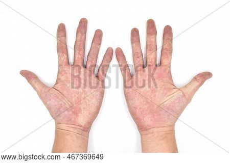 Cyanotic Hands Image & Photo (Free Trial) | Bigstock