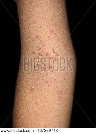 Multiple Red Spots Image & Photo (Free Trial) | Bigstock