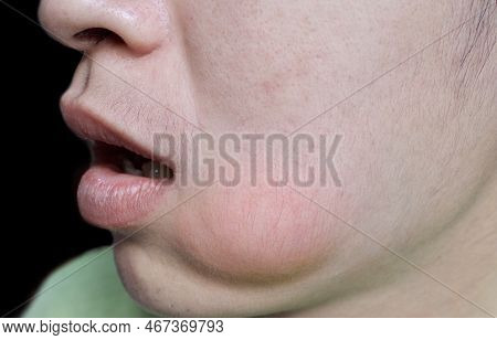 Swelling Cheek Asian Image & Photo (Free Trial) | Bigstock