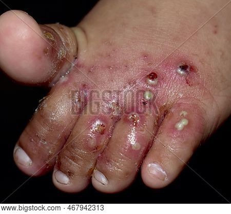 Scabies Infestation Image & Photo (Free Trial) | Bigstock