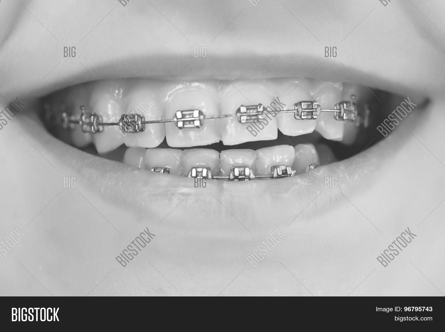 Closeup Teeth Brackets Image & Photo (Free Trial) | Bigstock