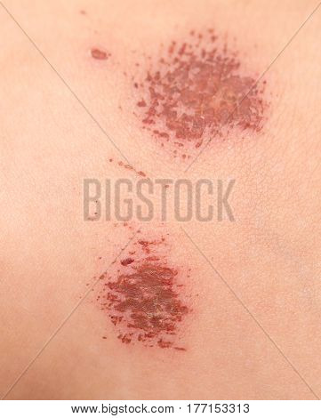 Wound Human Skin . Image & Photo (Free Trial) | Bigstock