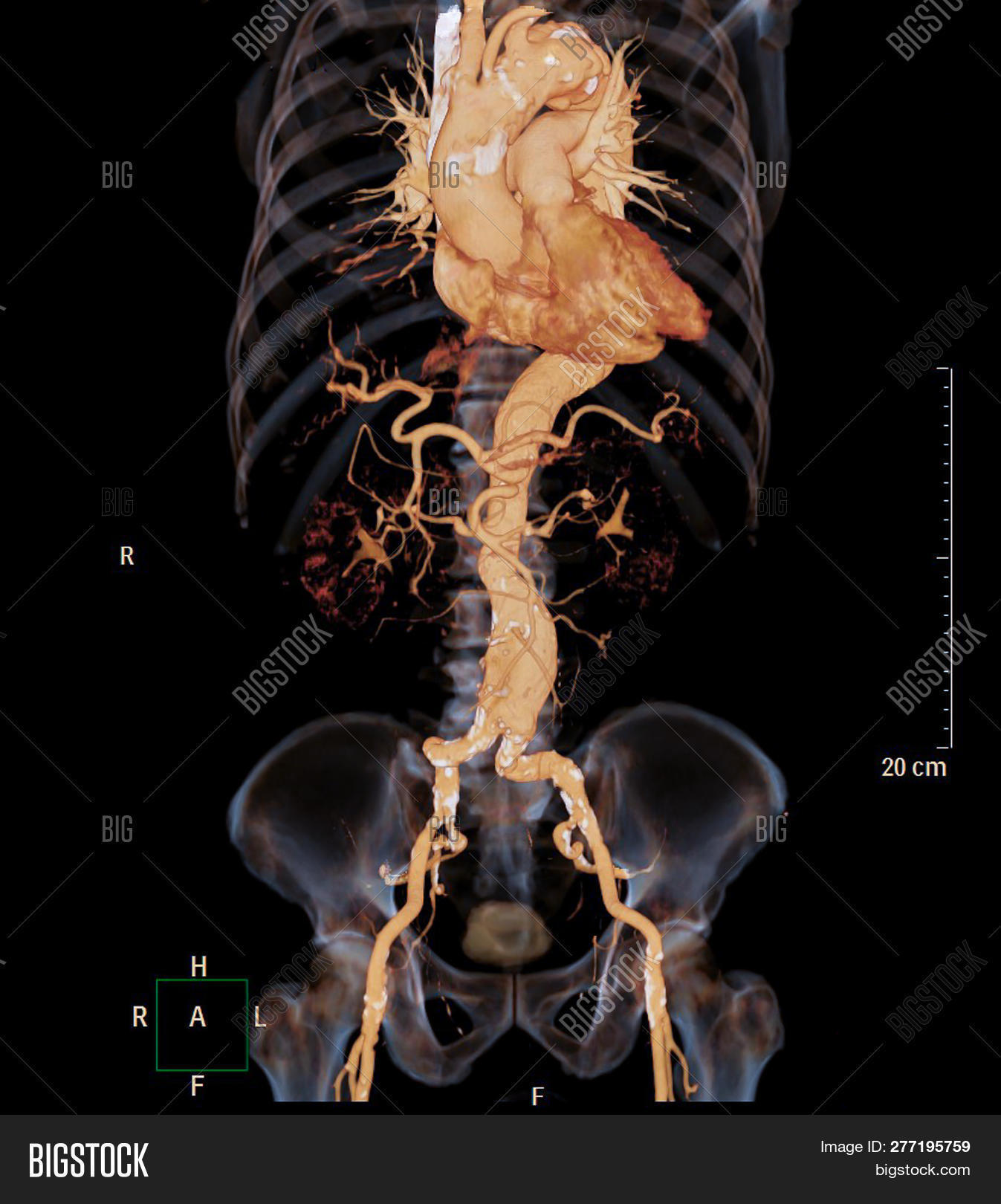 Ct Angiography Image & Photo (Free Trial) | Bigstock