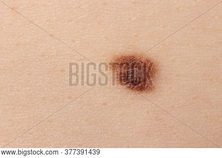 Mole Birthmark Nevus Image & Photo (Free Trial) | Bigstock