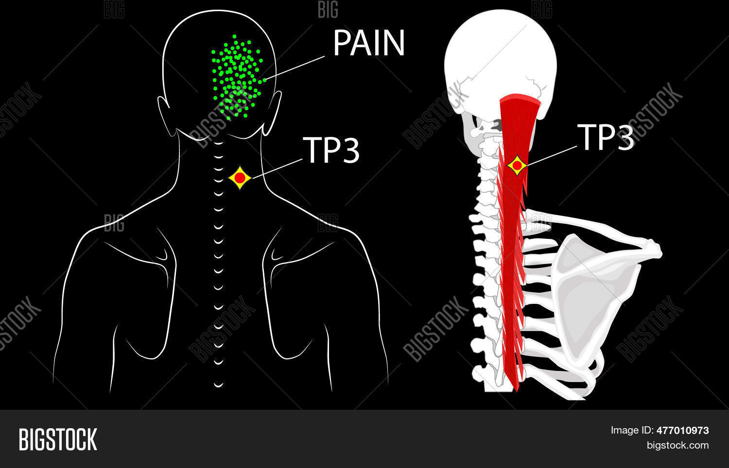 Semispinalis Muscles. Image & Photo (Free Trial) | Bigstock