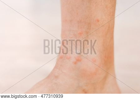 Close Allergic Rash Image & Photo (Free Trial) | Bigstock