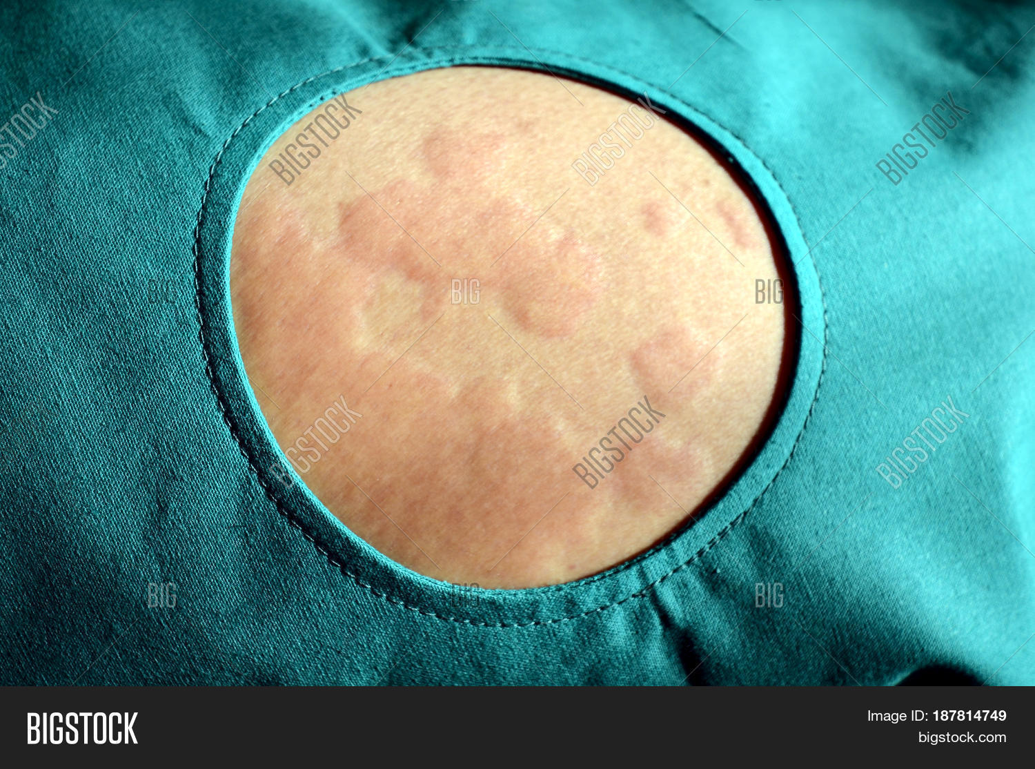 Skin Rash Urticaria Image & Photo (Free Trial) | Bigstock
