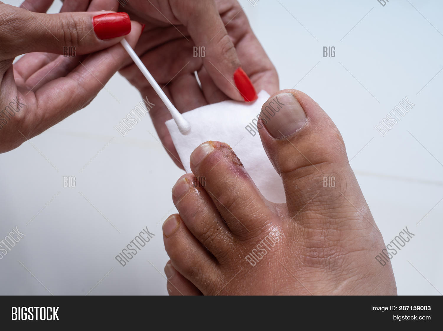 Finger On Leg. Image & Photo (Free Trial) | Bigstock