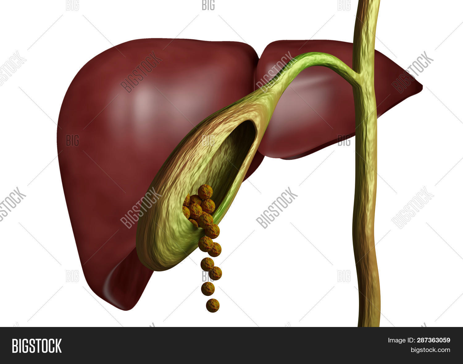 Gallstones Gallbladder Image & Photo (Free Trial) | Bigstock