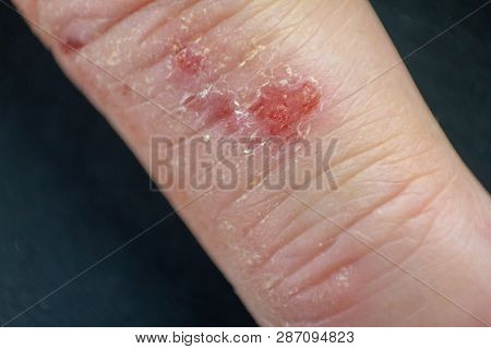 Hand Dermatitis. Hand Image & Photo (Free Trial) | Bigstock
