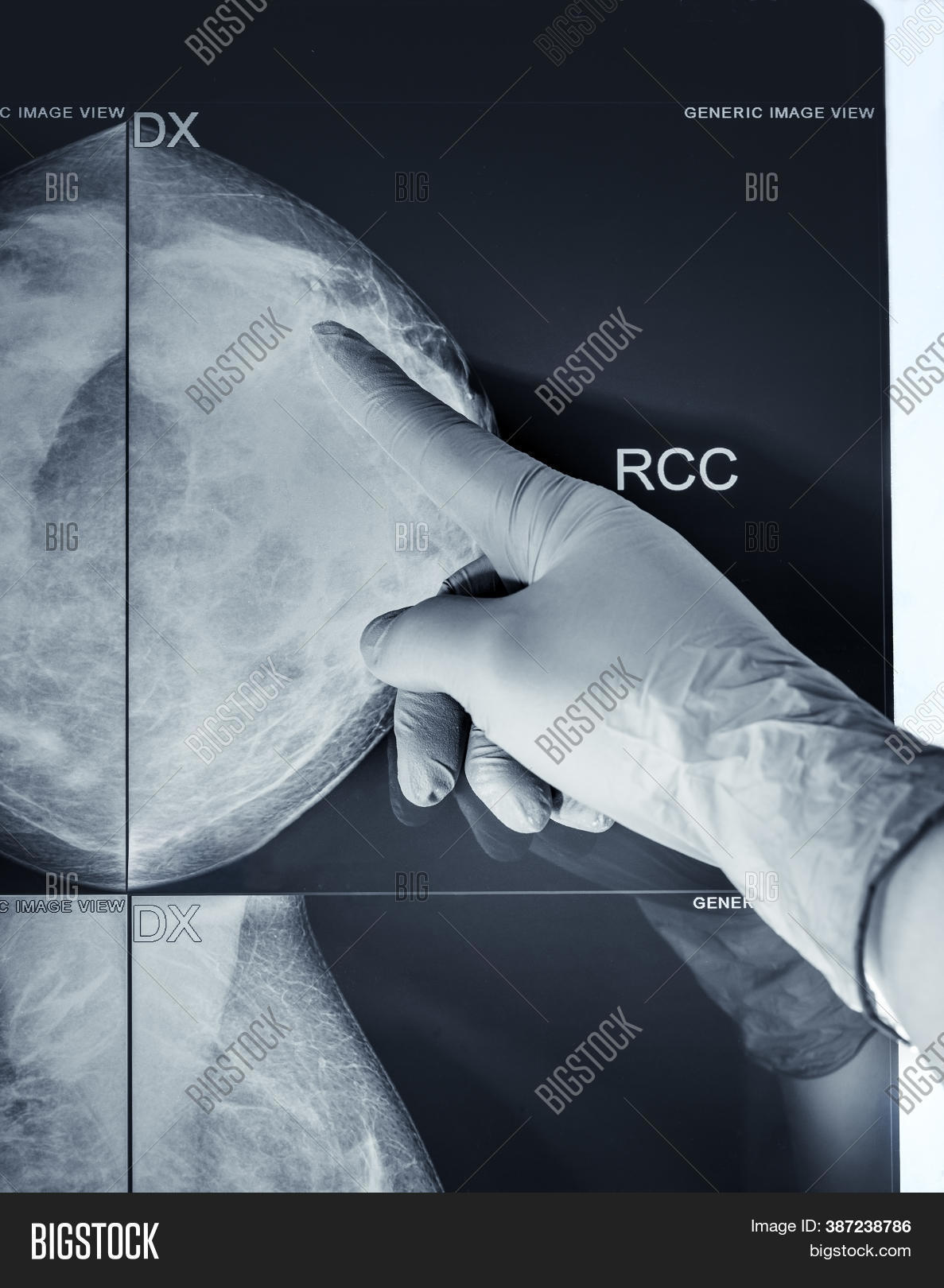 X-ray Mammography Image & Photo (Free Trial) | Bigstock