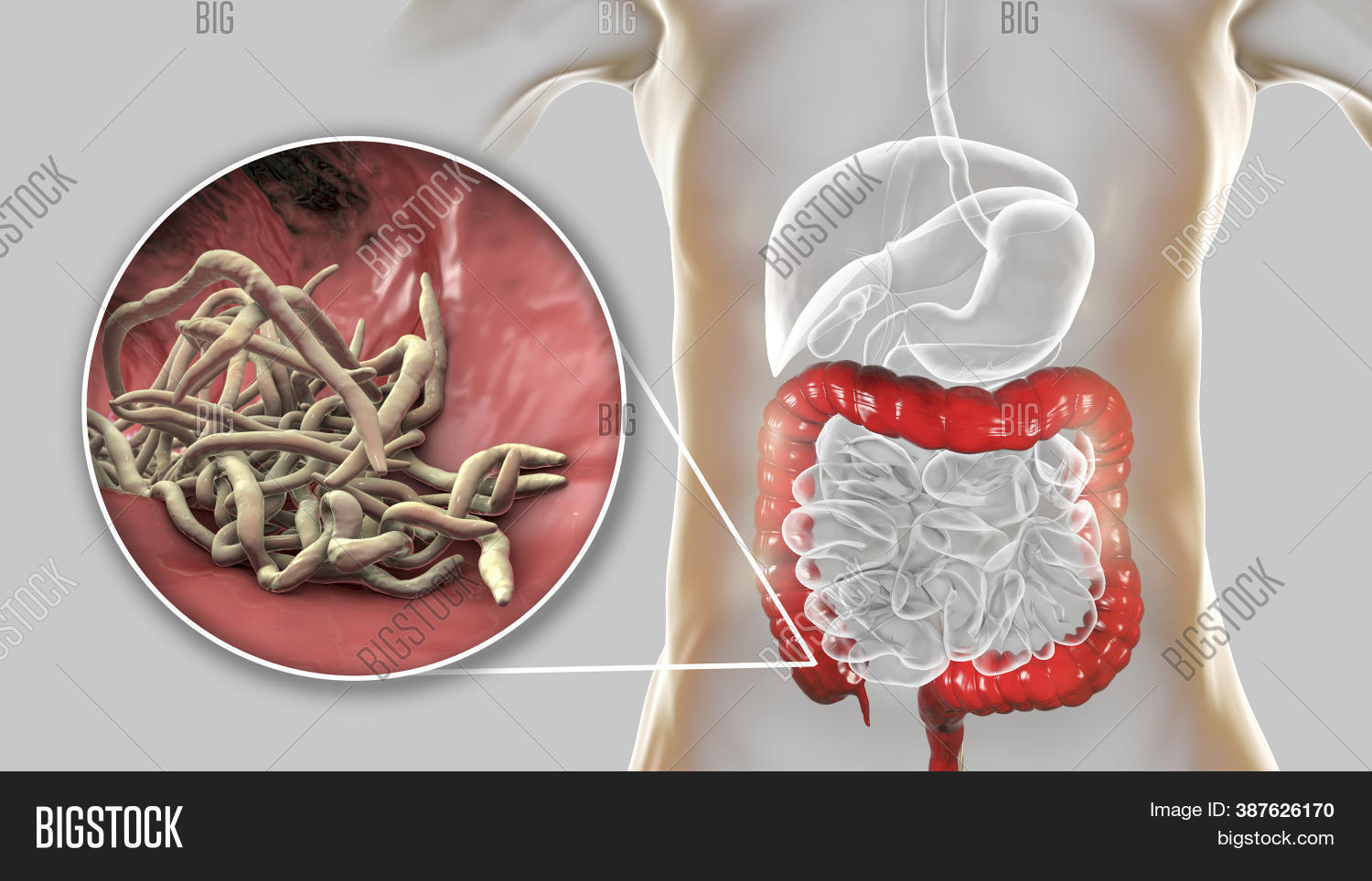 Parasitic Worms Human Image & Photo (Free Trial) | Bigstock
