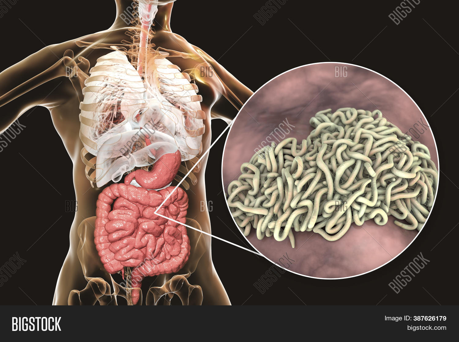 Parasitic Worms Human Image & Photo (Free Trial) | Bigstock