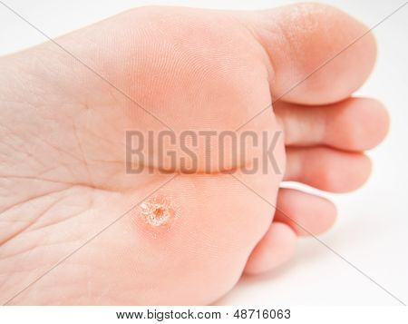 Callus Under Foot Image & Photo (Free Trial) | Bigstock
