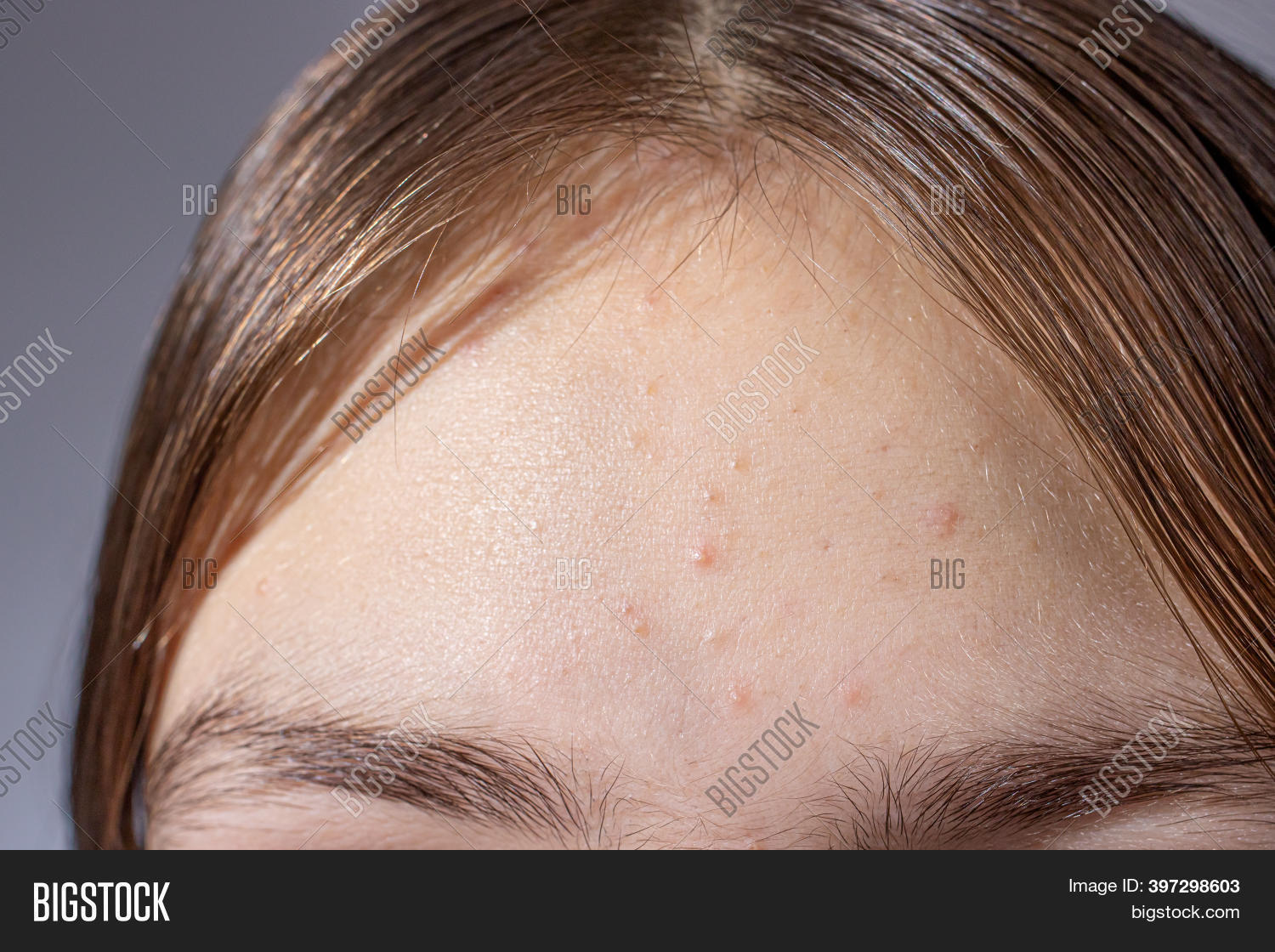 Acne On Forehead Image & Photo (Free Trial) | Bigstock