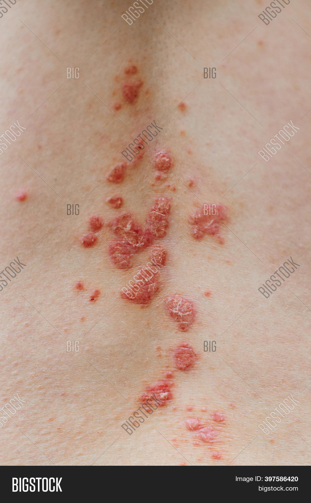 Psoriasis Vulgaris Image & Photo (Free Trial) | Bigstock