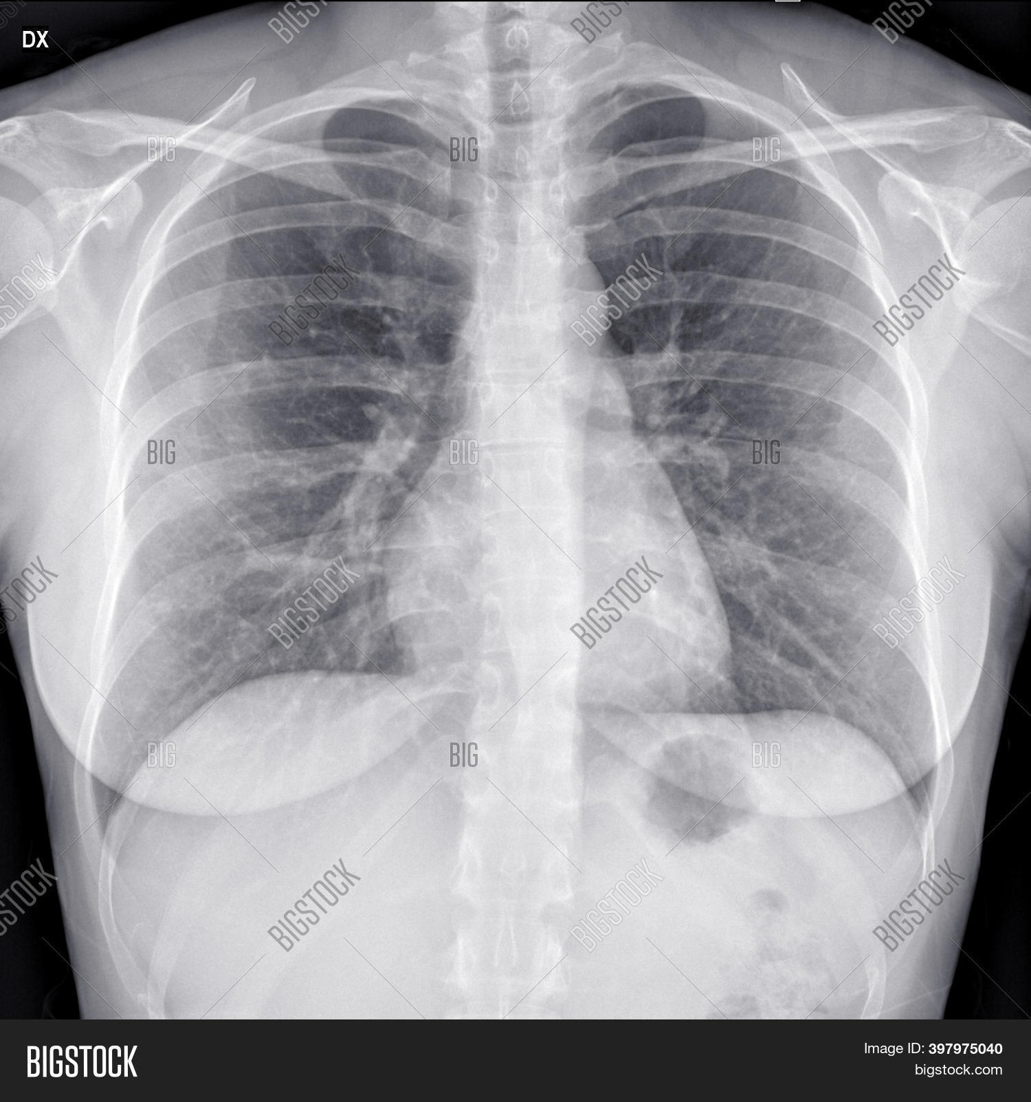 Woman Chest X-ray. Image & Photo (Free Trial) | Bigstock