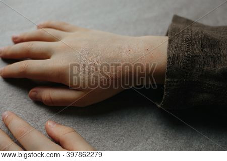 Children Hand Atopic Image & Photo (Free Trial) | Bigstock
